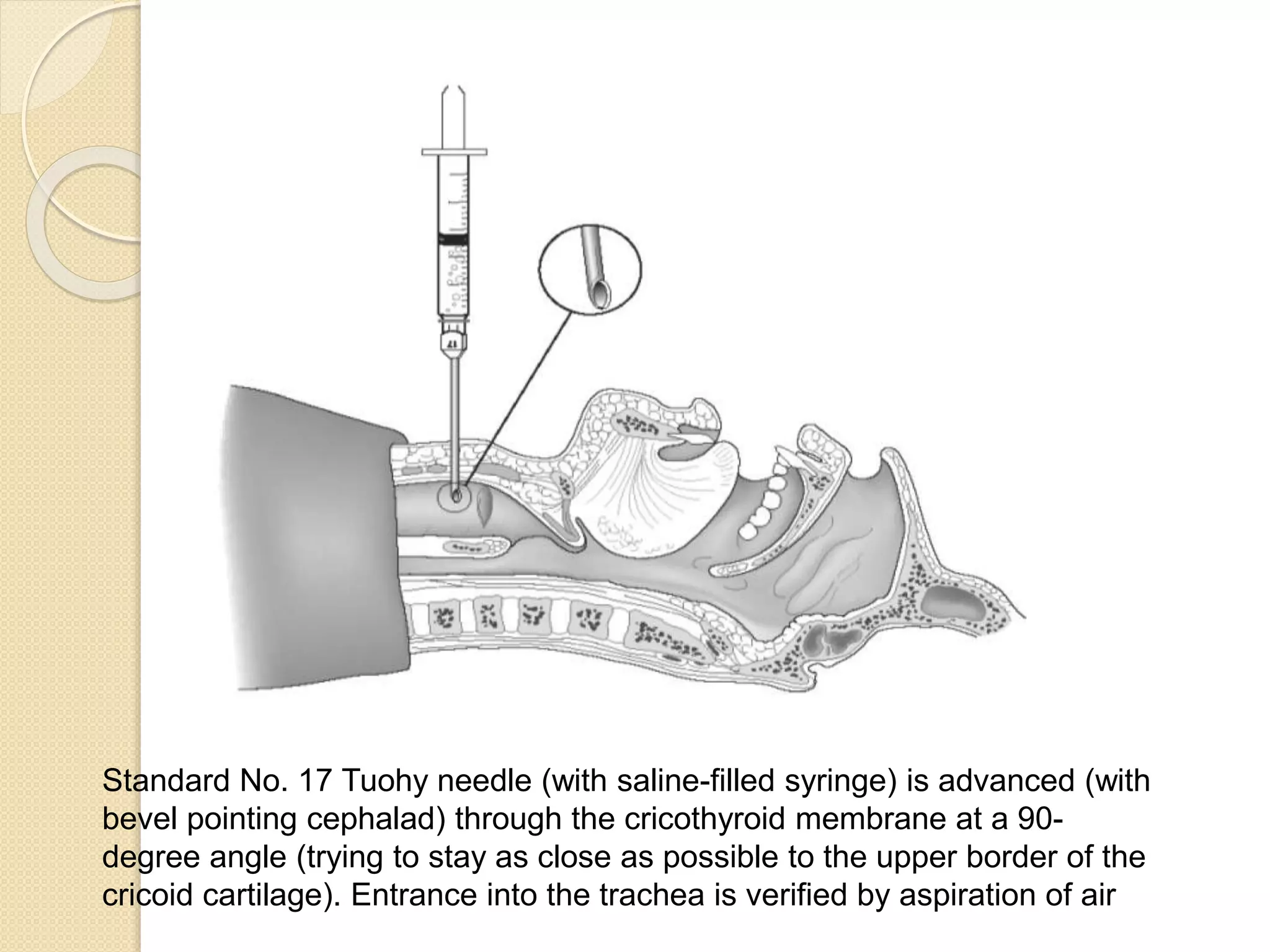 Retrograde intubation | PPTX