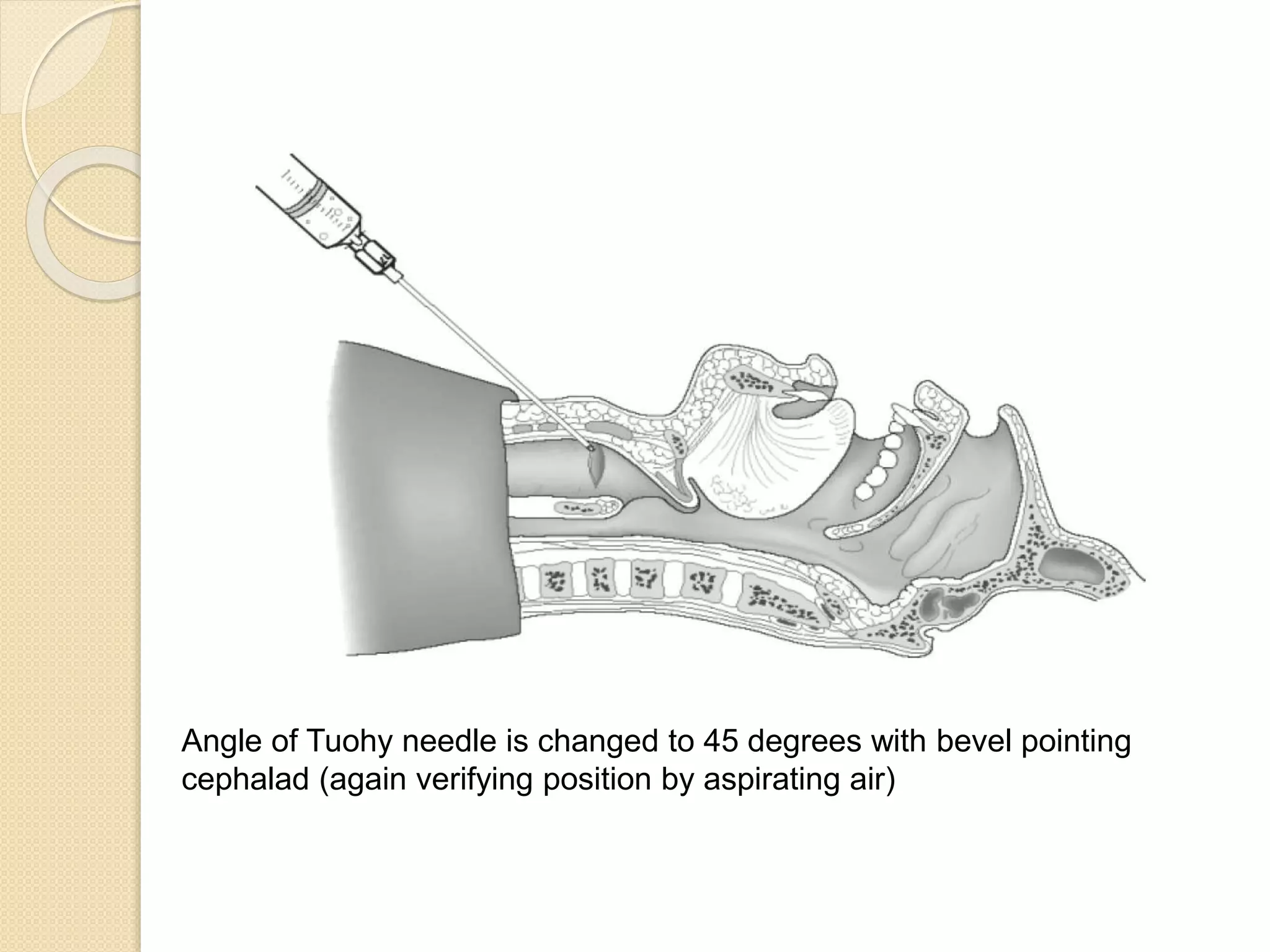 Retrograde intubation | PPTX