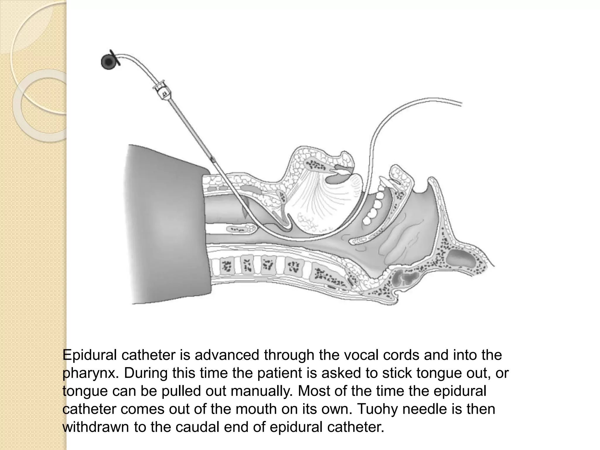Retrograde intubation | PPTX