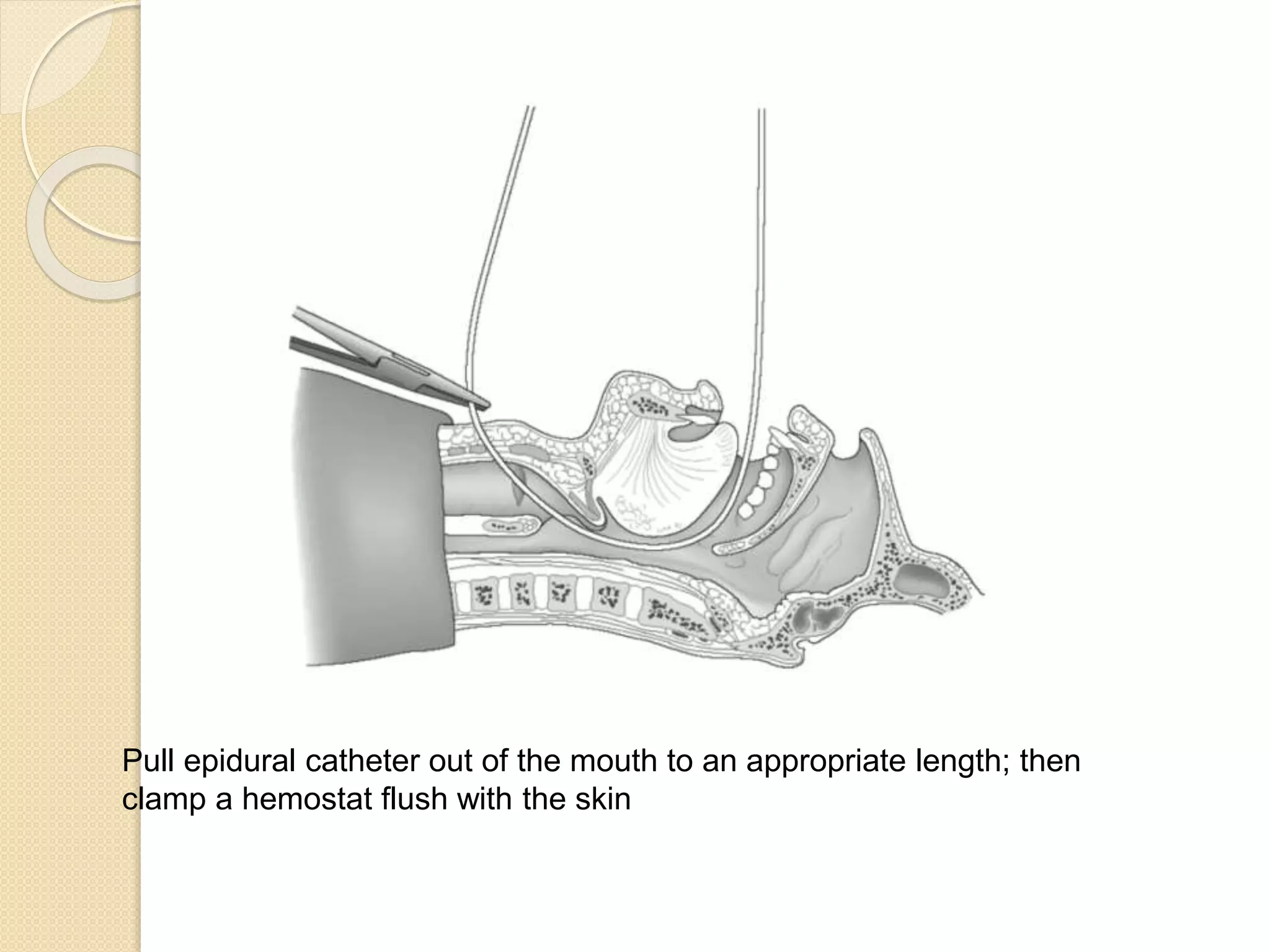 Retrograde intubation | PPTX