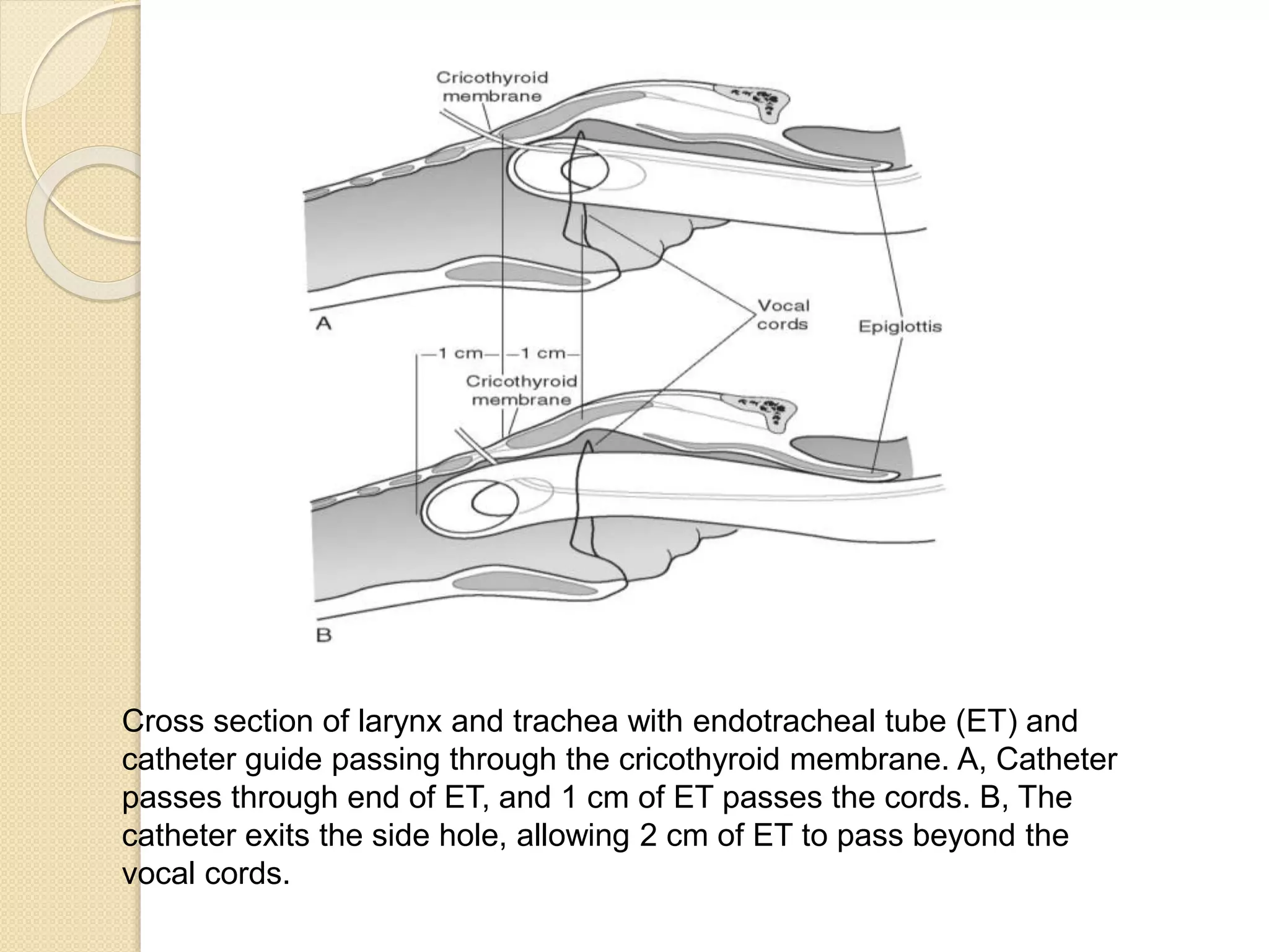 Retrograde intubation | PPTX