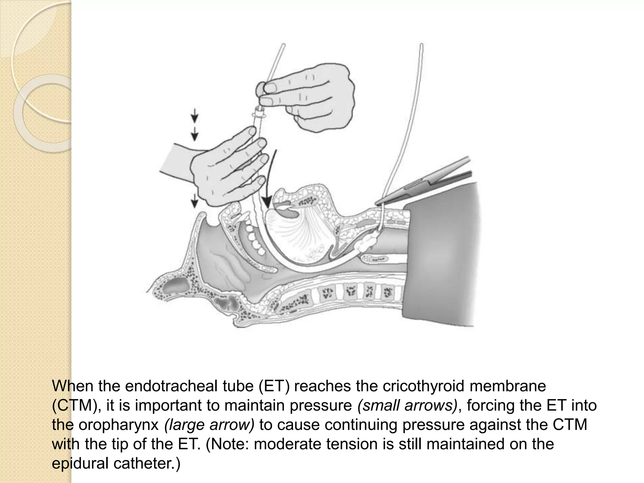 Retrograde intubation | PPTX