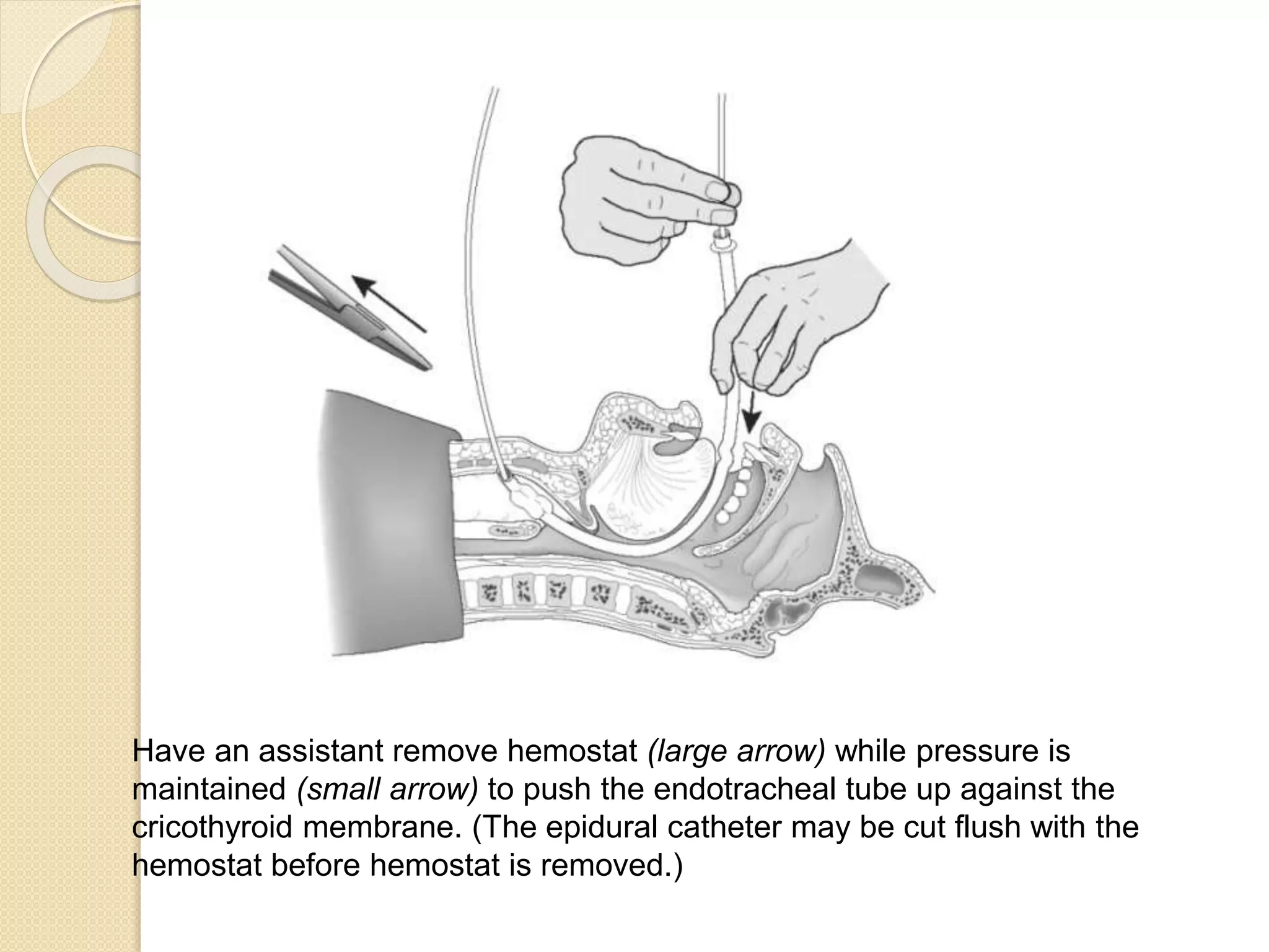 Retrograde intubation | PPTX