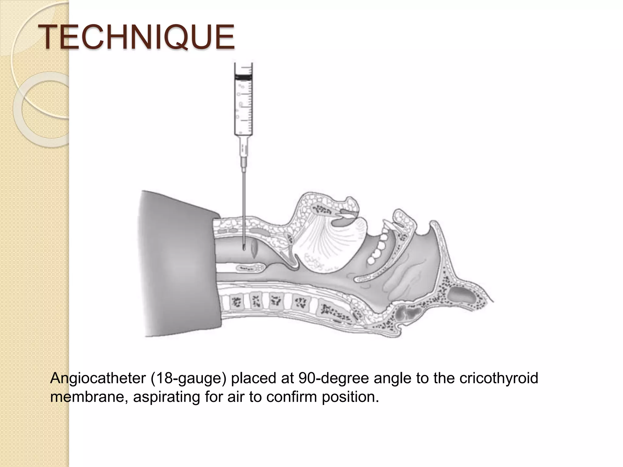 Retrograde intubation | PPTX