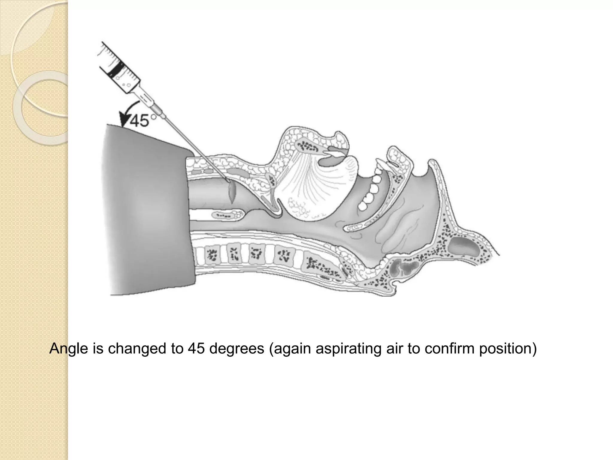 Retrograde intubation | PPTX