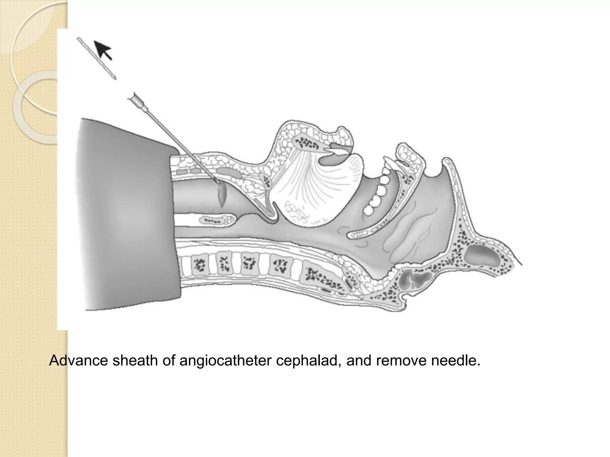 Retrograde intubation | PPTX