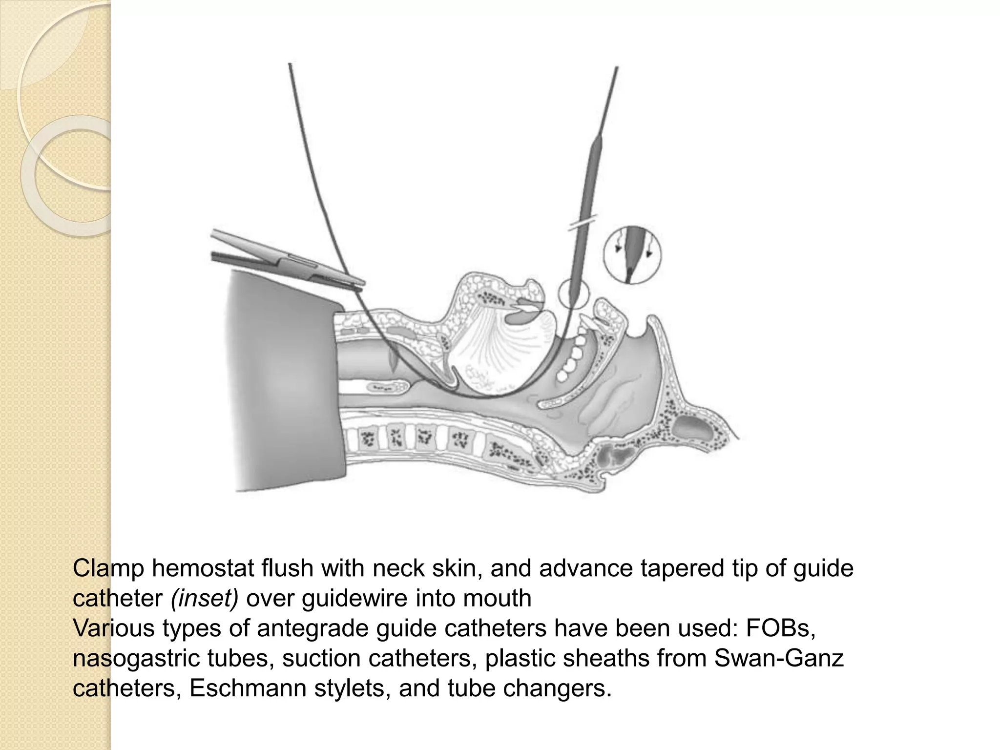 Retrograde intubation | PPTX