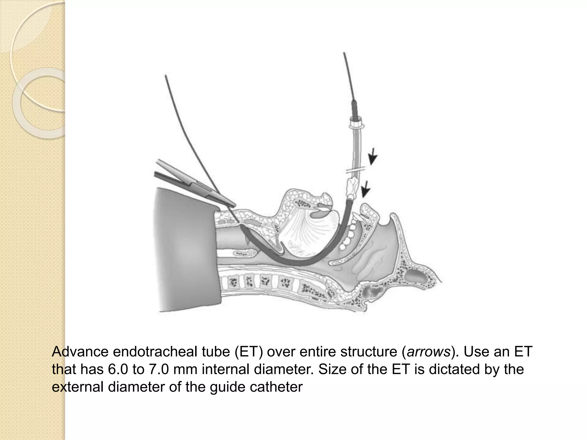 Retrograde intubation | PPTX