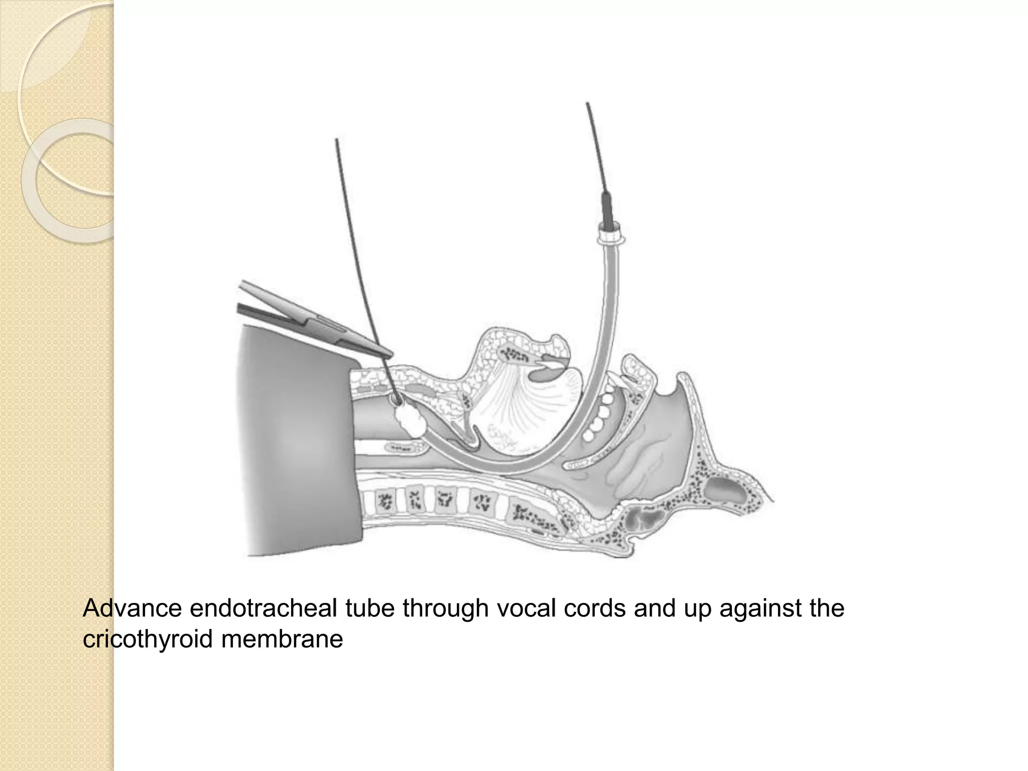 Retrograde intubation | PPTX