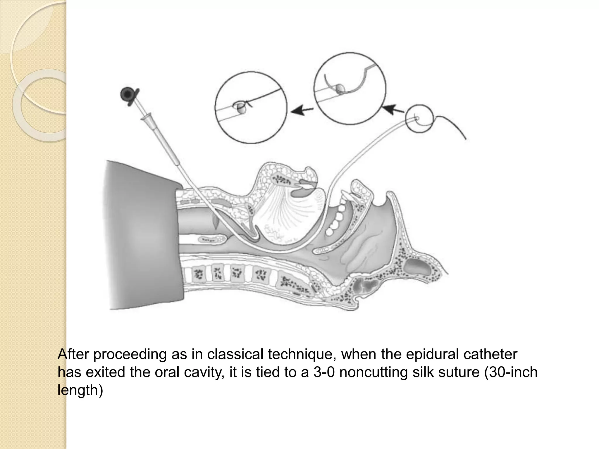 Retrograde intubation | PPTX