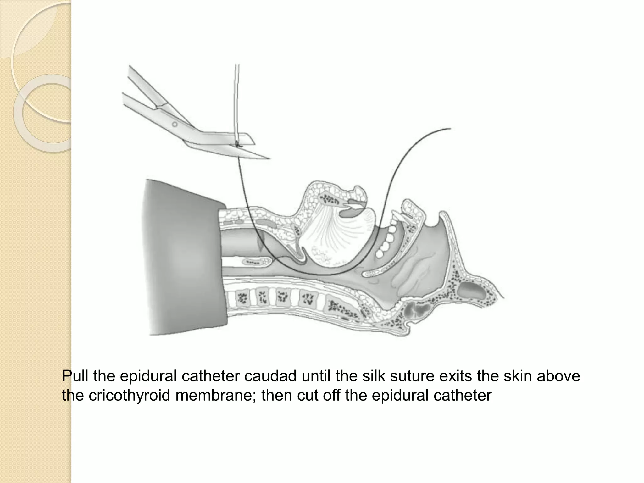 Retrograde intubation | PPTX