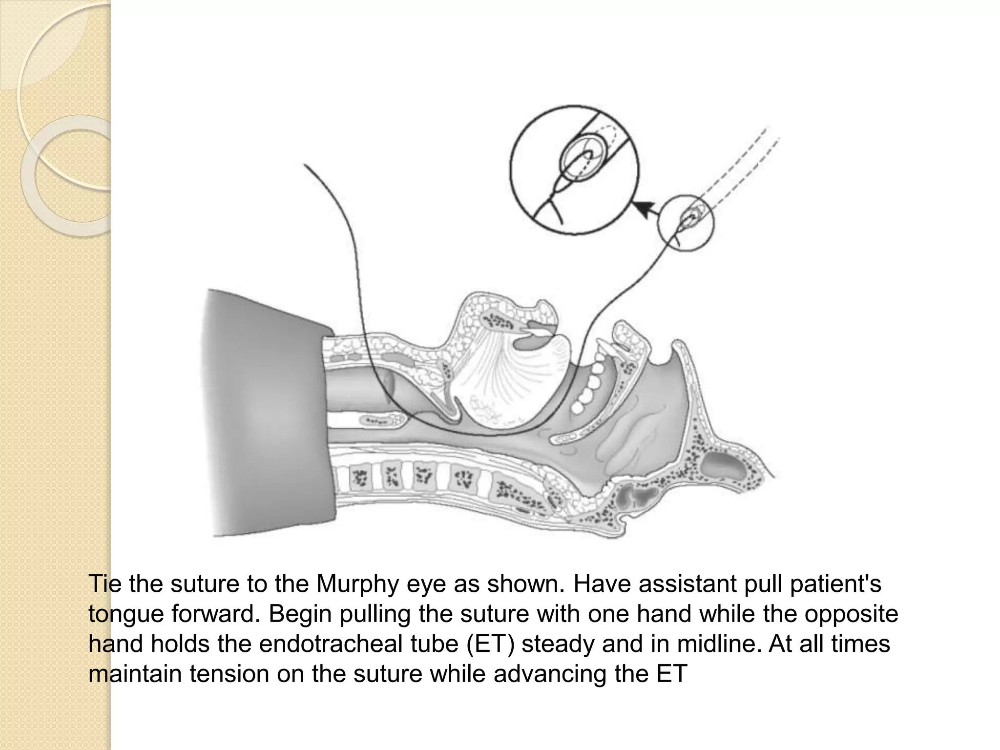 Retrograde intubation | PPTX