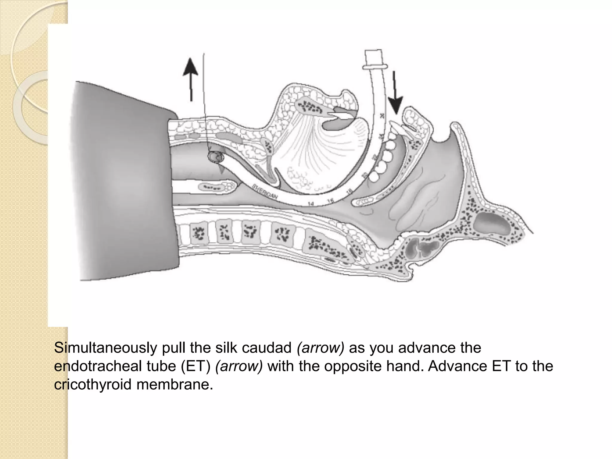 Retrograde intubation | PPTX