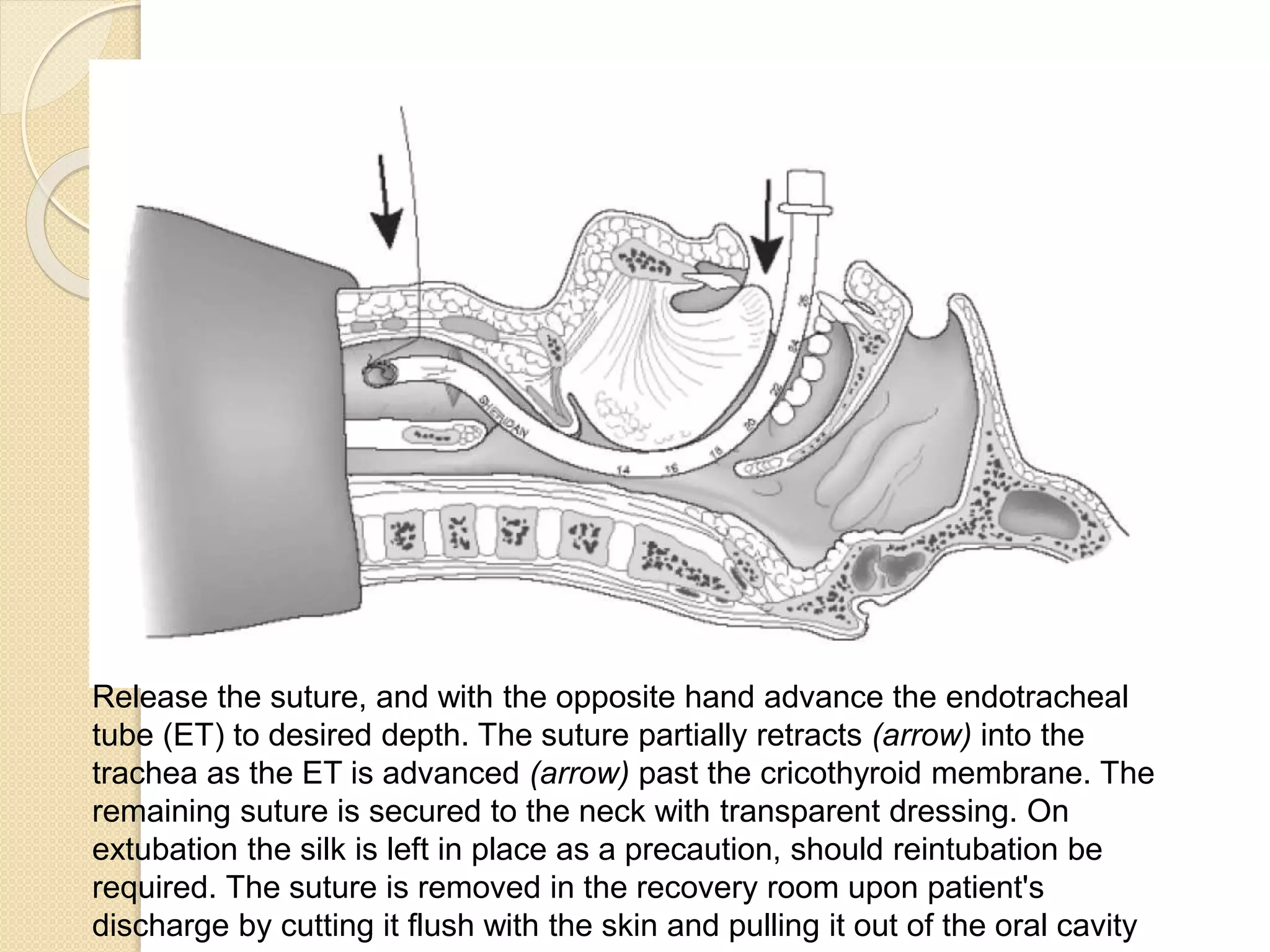 Retrograde intubation | PPTX