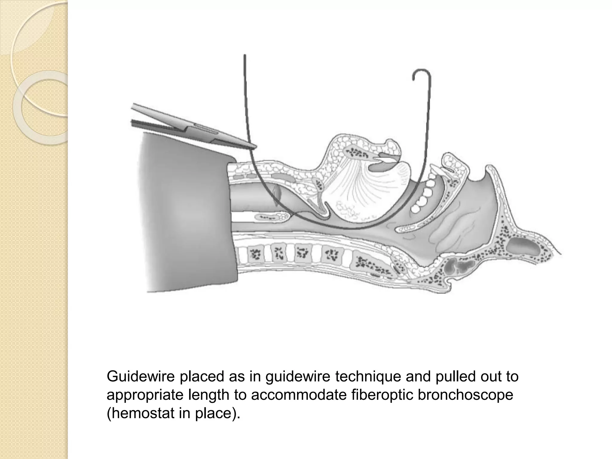Retrograde intubation | PPTX