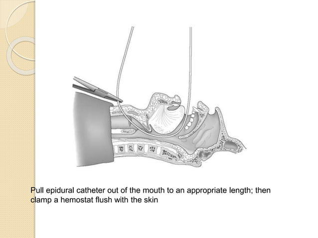 Retrograde intubation | PPTX | First Aid | Injuries