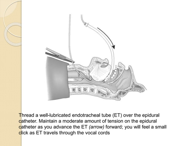 Retrograde intubation | PPTX | First Aid | Injuries