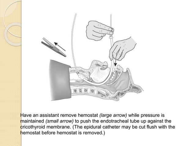 Retrograde intubation | PPTX | First Aid | Injuries