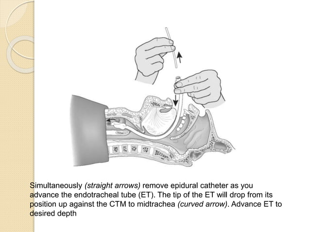 Retrograde intubation | PPTX | First Aid | Injuries