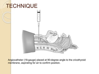 Retrograde intubation | PPTX