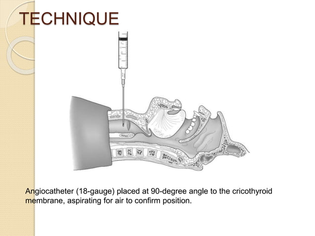 Retrograde intubation | PPTX | First Aid | Injuries