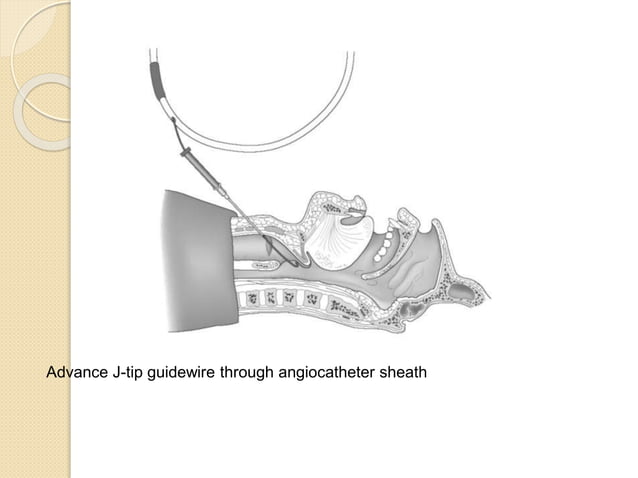 Retrograde intubation | PPTX | First Aid | Injuries