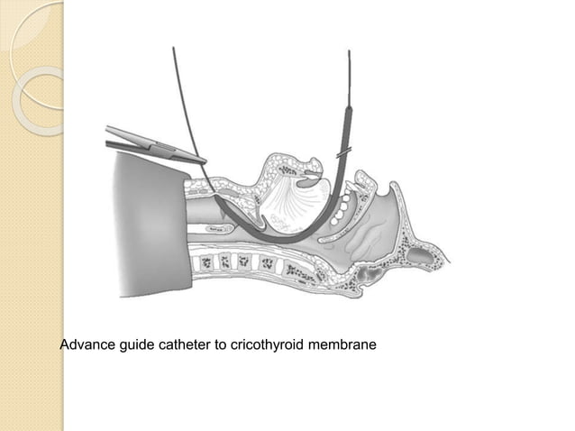 Retrograde intubation | PPTX | First Aid | Injuries