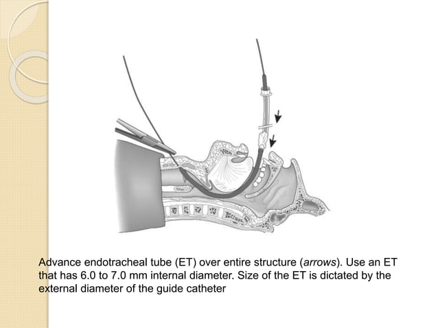 Retrograde intubation | PPTX | First Aid | Injuries