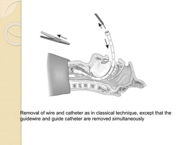 Retrograde intubation | PPTX | First Aid | Injuries