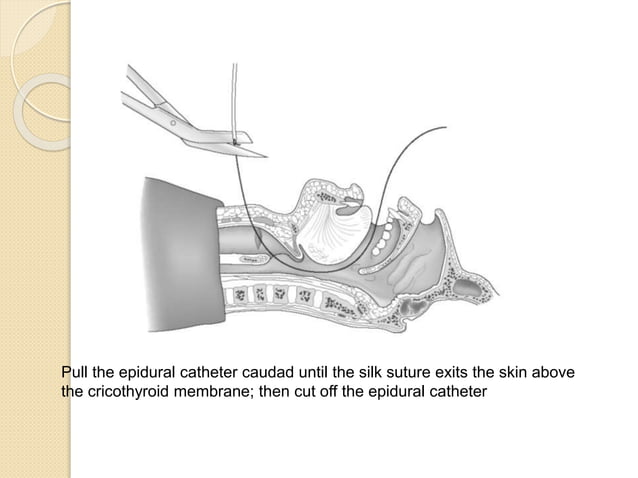 Retrograde intubation | PPTX | First Aid | Injuries