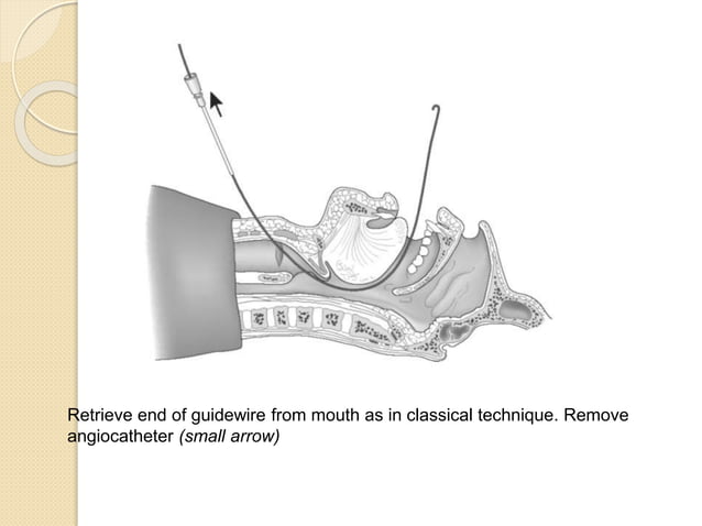 Retrograde intubation