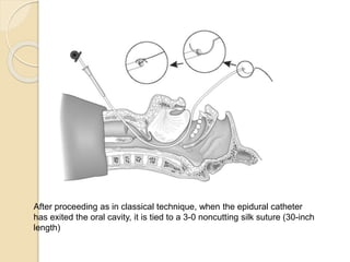 Retrograde intubation | PPT
