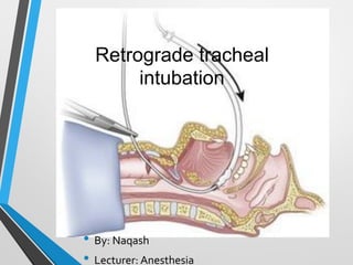 retrograde intubation ( Difficult Intubation ) | PDF