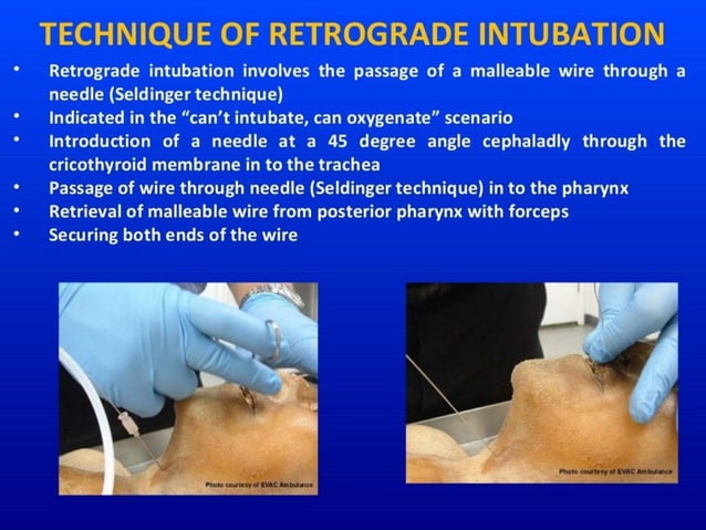 retrograde intubation ( Difficult Intubation ) | PDF