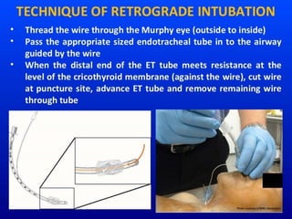 retrograde intubation ( Difficult Intubation ) | PDF