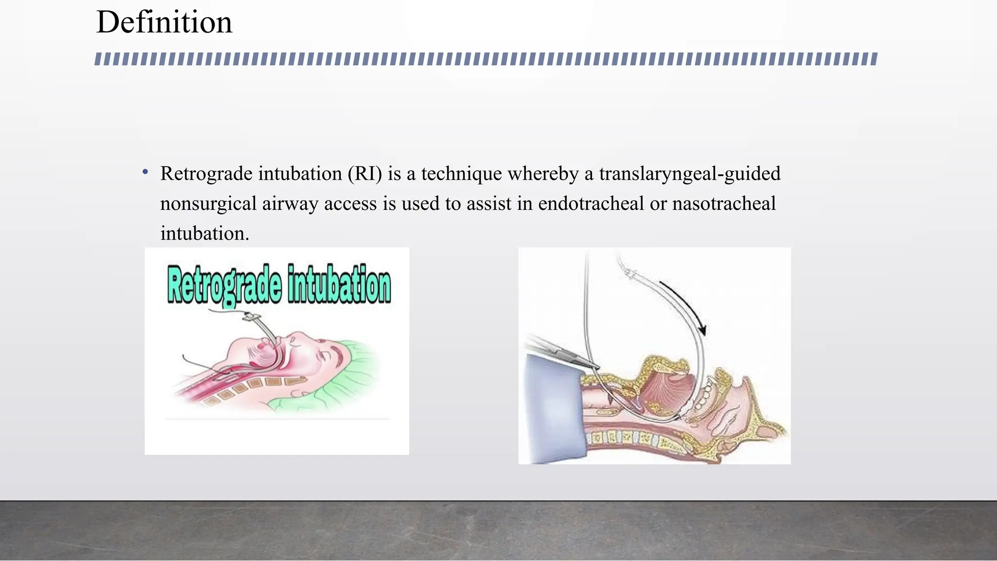 Retrograde Intubation - techniques .pptx