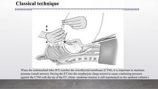 Retrograde Intubation - techniques .pptx