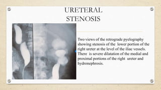 Retrograde pyeloureterography | PPTX