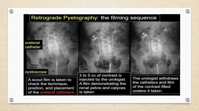 Retrograde pyeloureterography | PPTX | Medical Tests | Medical Health