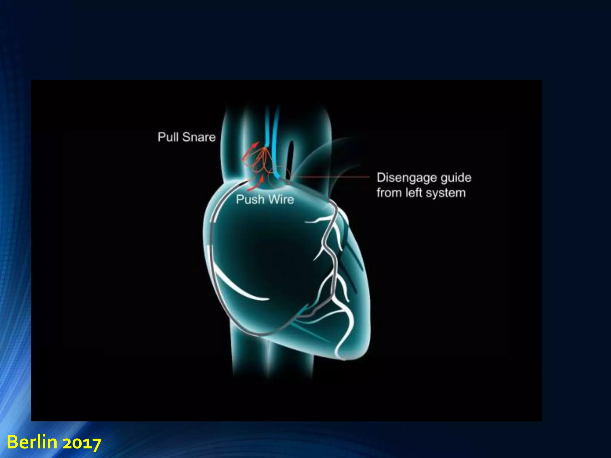Retrograde – step by step approach | PPTX