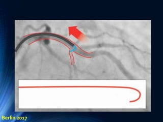 Retrograde – step by step approach | PPTX