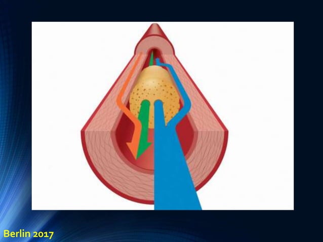 Retrograde – step by step approach | PPTX | Heart and Cardiovascular ...