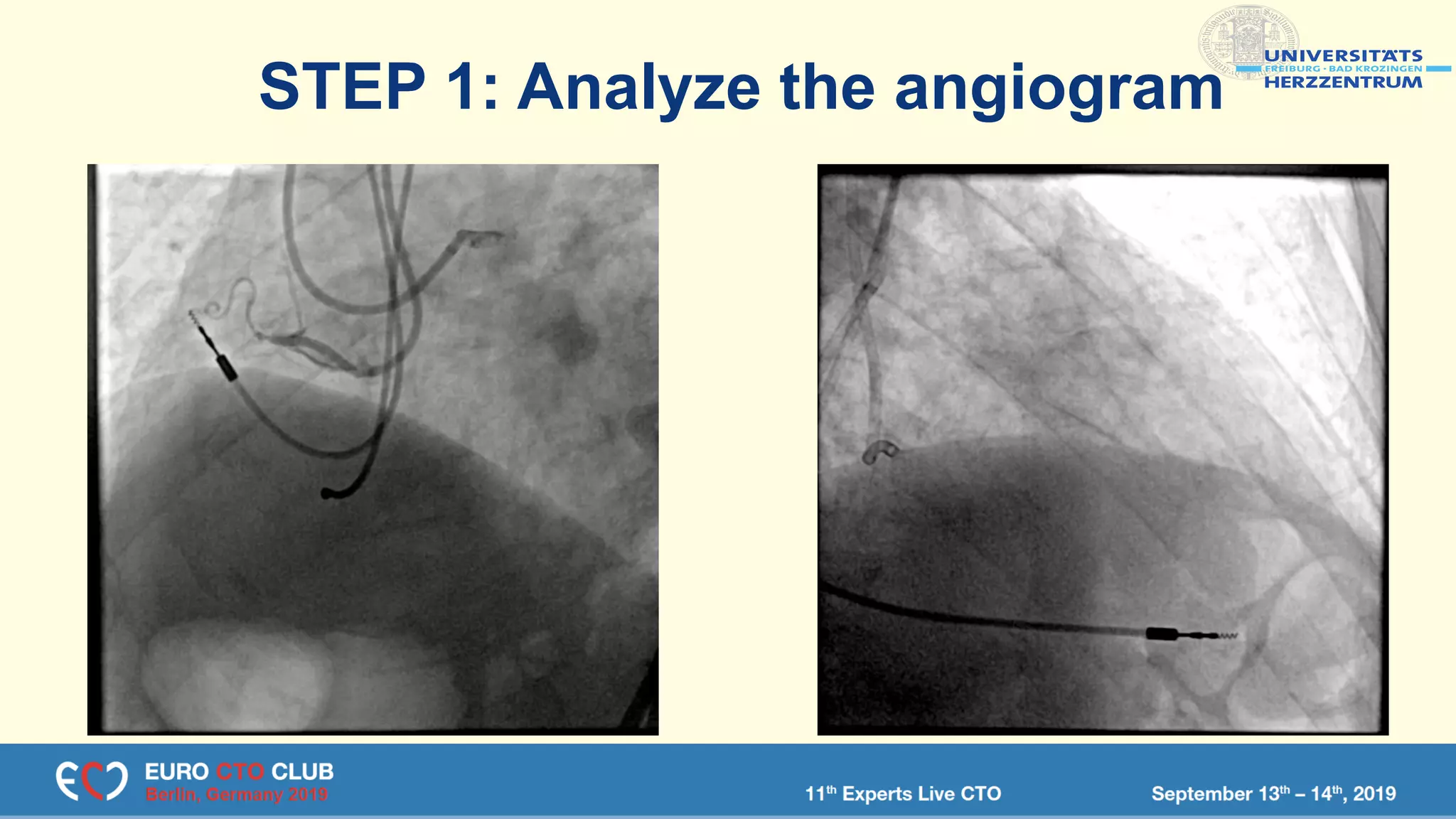 Retrograde approach Step by Step | PDF
