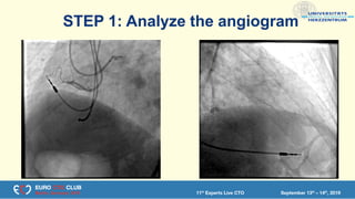 Retrograde approach Step by Step | PPT