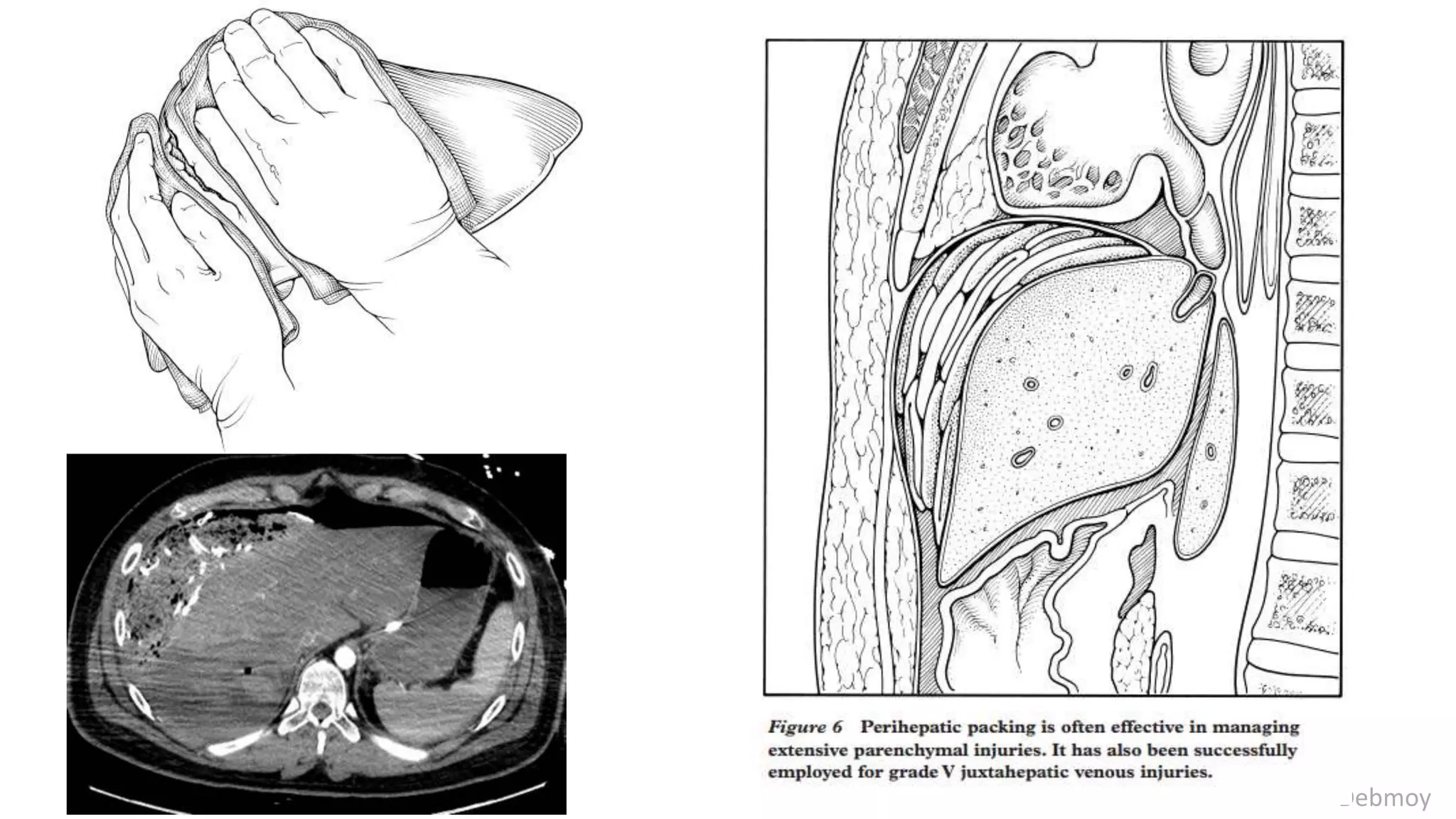 Retrohepatic IVC Injuries Evaluation and Assessment.pptx