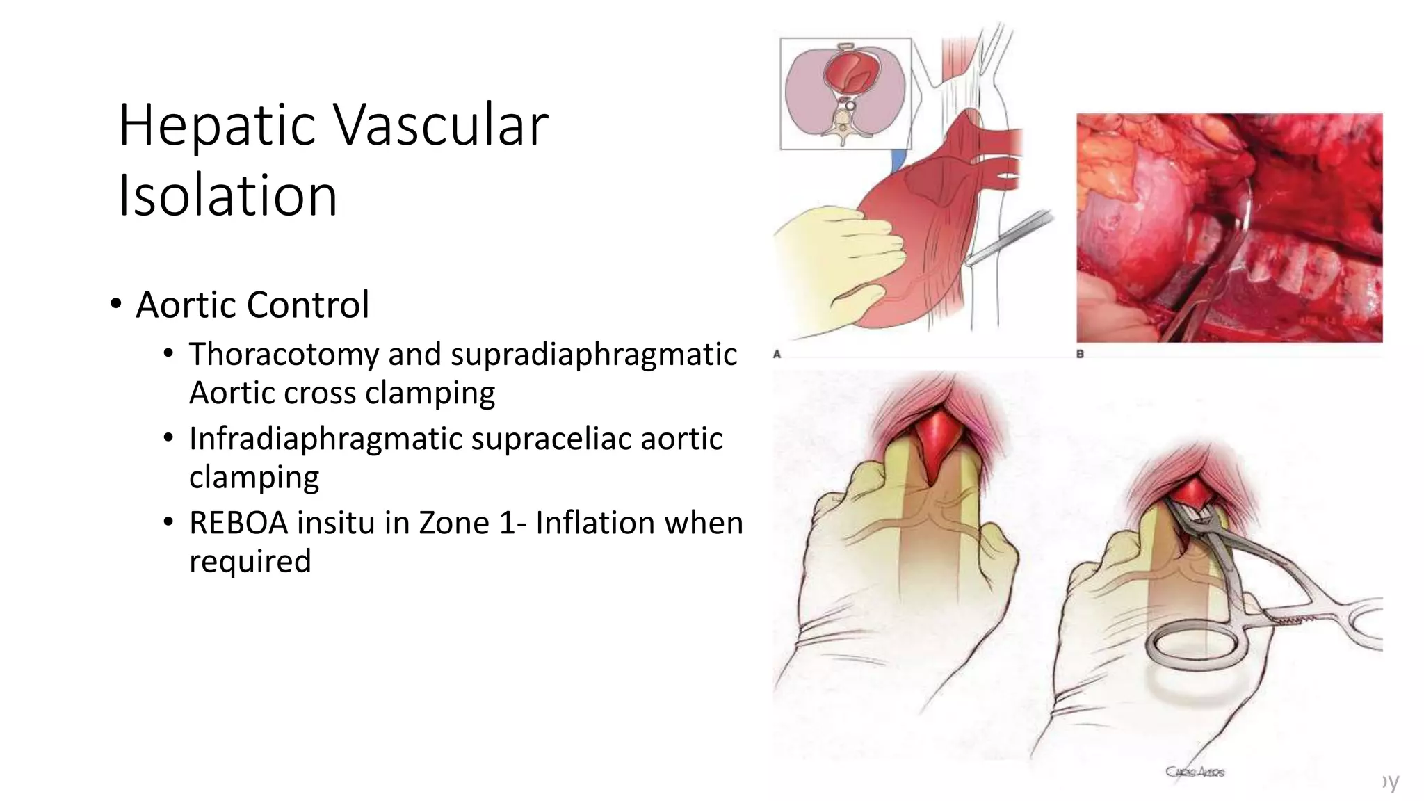 Retrohepatic IVC Injuries Evaluation and Assessment.pptx