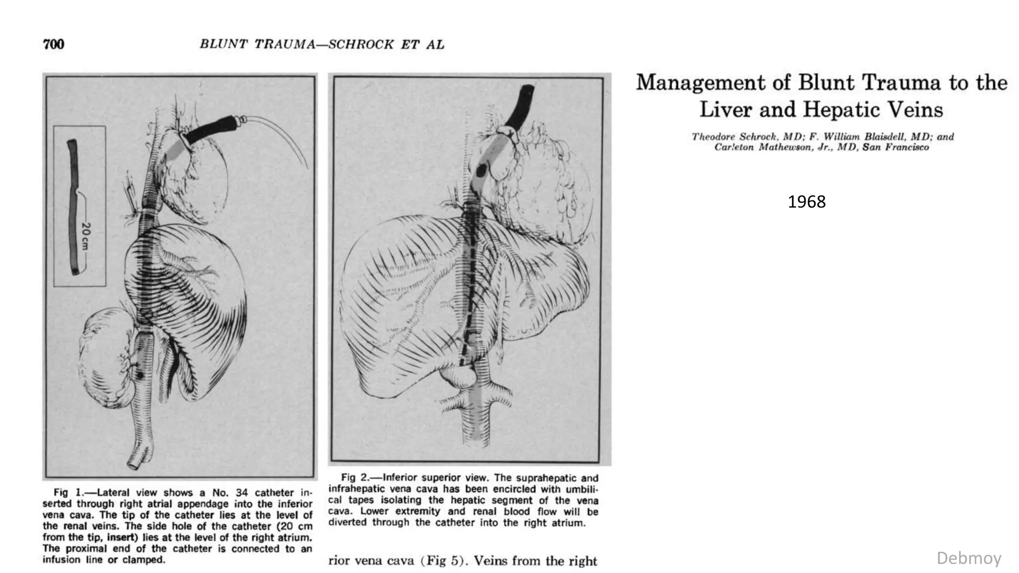 Retrohepatic IVC Injuries Evaluation and Assessment.pptx