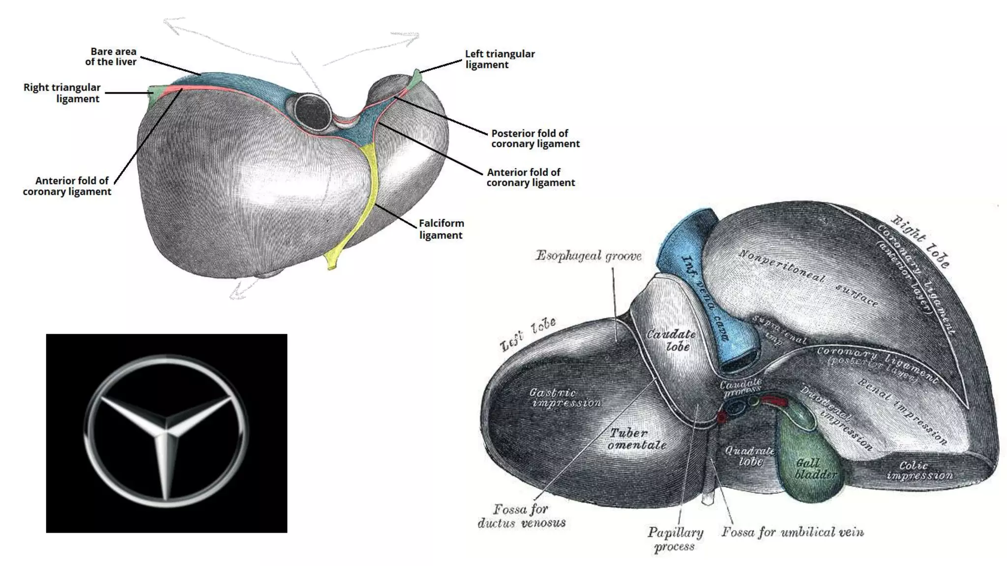 Retrohepatic IVC Injuries Evaluation and Assessment.pptx