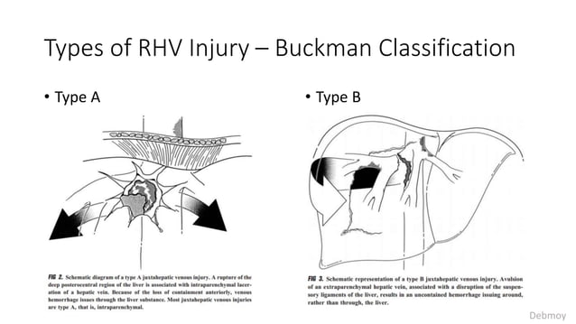 Retrohepatic IVC Injuries Evaluation and Assessment.pptx