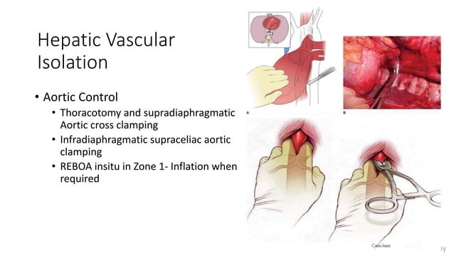 Retrohepatic IVC Injuries Evaluation and Assessment.pptx